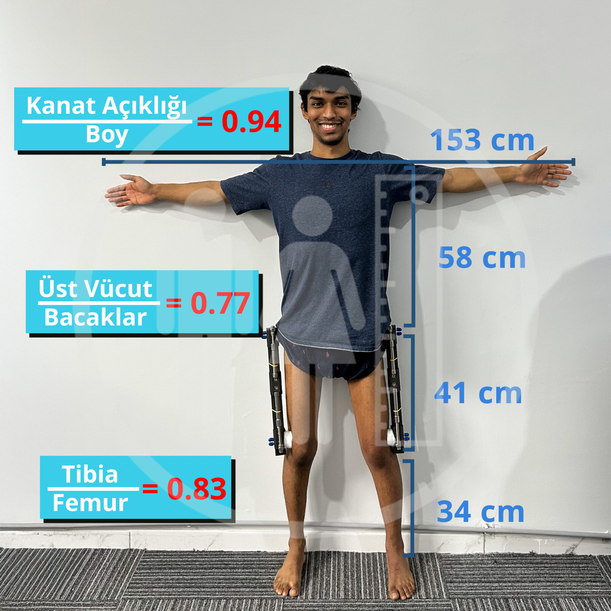 Boy Uzatma Ameliyatı Sonrası Görünüm - Boy Uzatma Ameliyatı